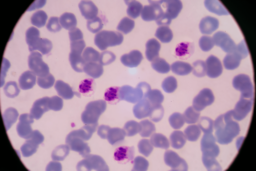 [MS Research] Multiple Sclerosis and Malarial Parasites Part 2 - Live ...